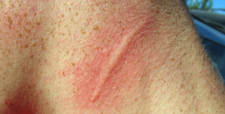 DERMOGRAFISMO è il segnale dell'ORTICARIA - Prof. Dr. Antonino Di Pietro