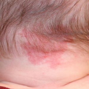 Dermatite da processionaria: come curarla? | Prof. Antonino di Pietro