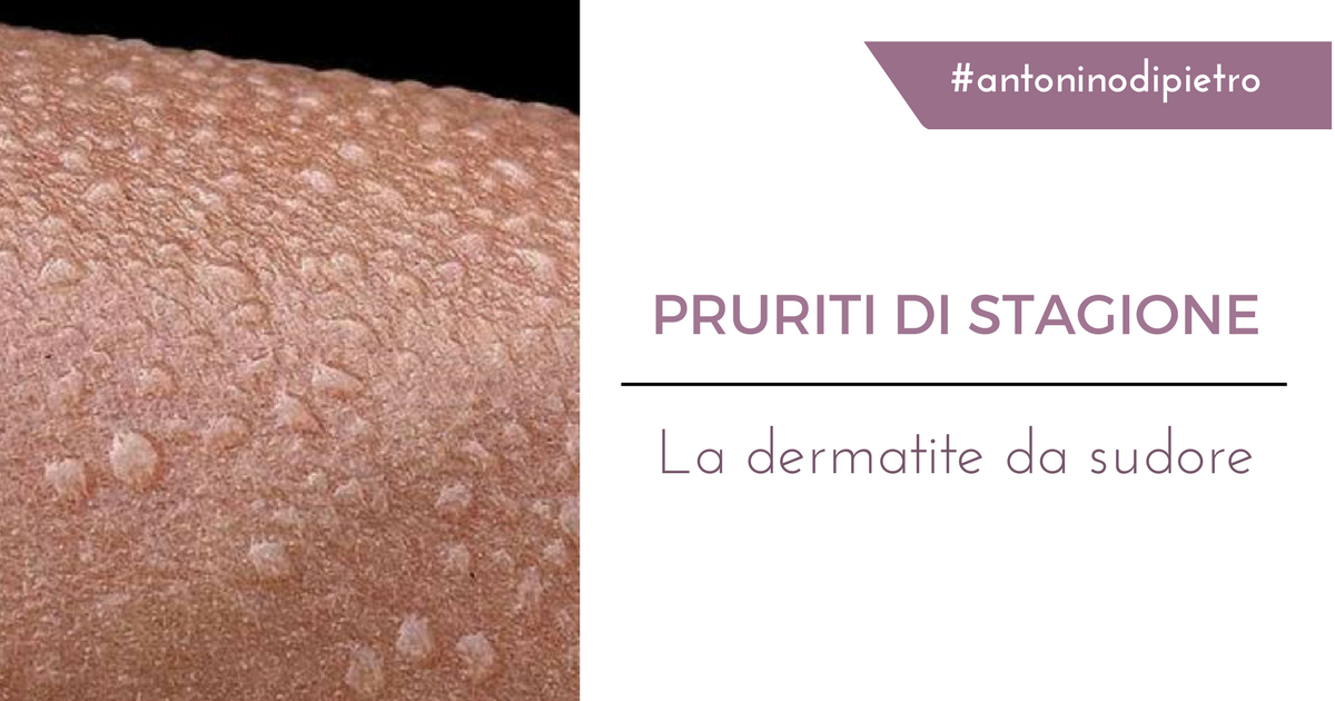 Pruriti di stagione: la dermatite da sudore - Prof. Antonino Di Pietro