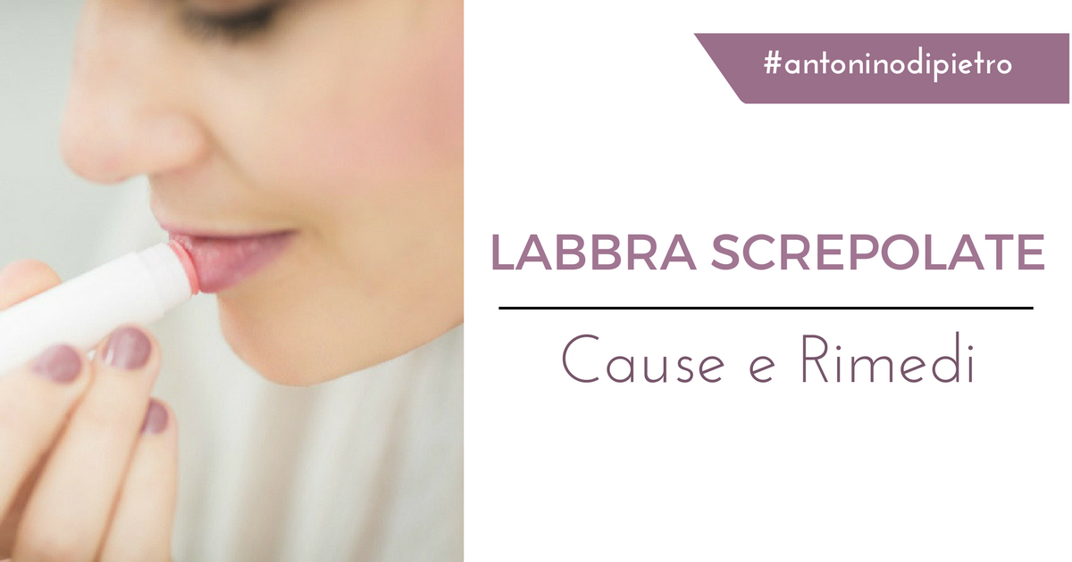 Labbra secche e screpolate: le cause e i rimedi | Prof. Antonino Di Pietro