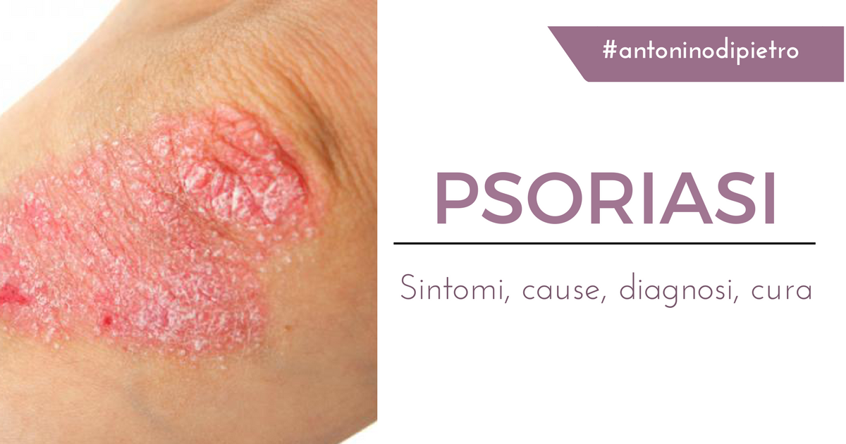 Psoriasi: sintomi, cause, diagnosi, cura - Prof. Antonino Di Pietro