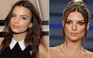 Bolla di Bichat: rischi della rimozione | Prof. Antonino di Pietro