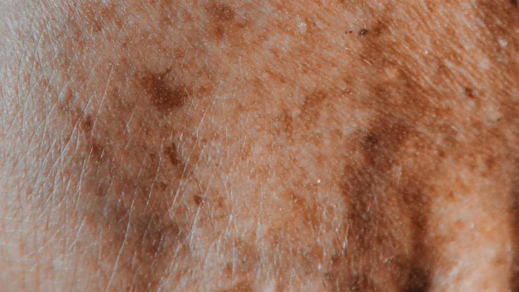 I trattamenti per prevenire le macchie senili - Prof. Dr. Antonino Di ...